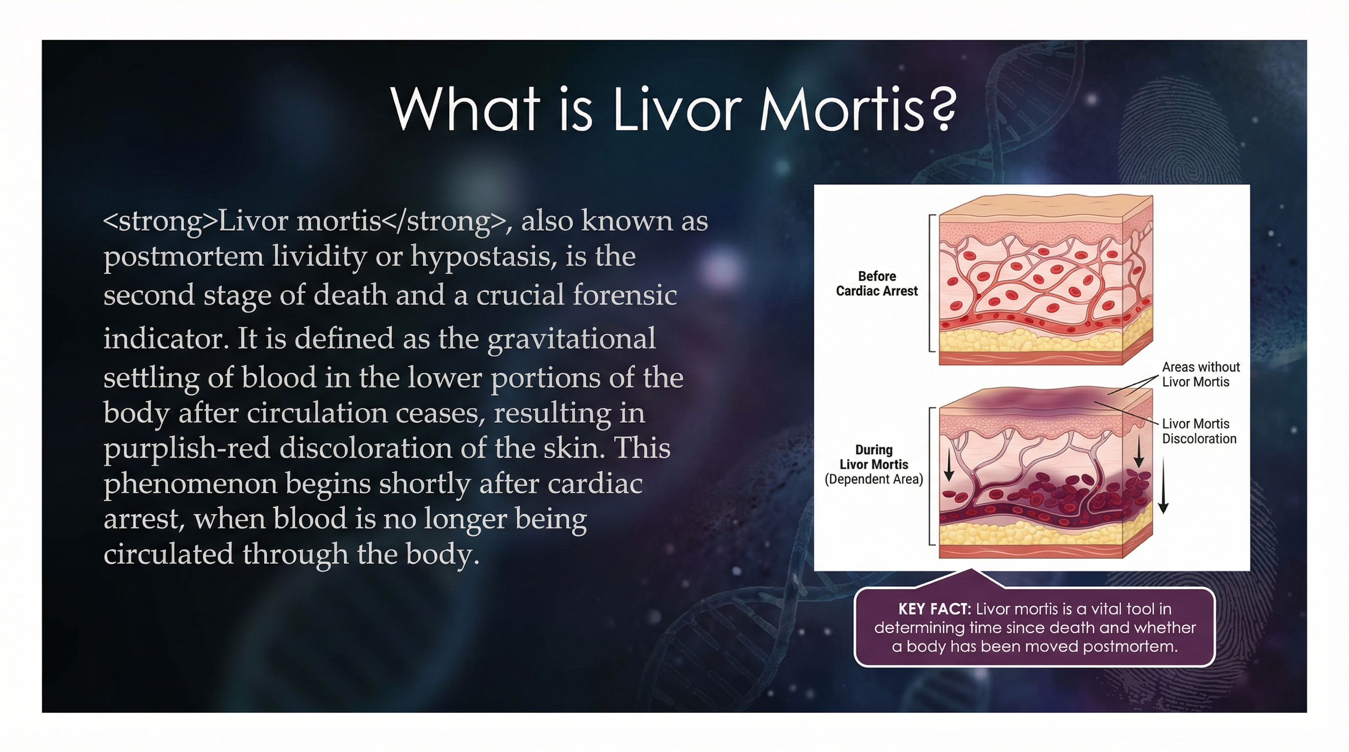 Livor Mortis Forense