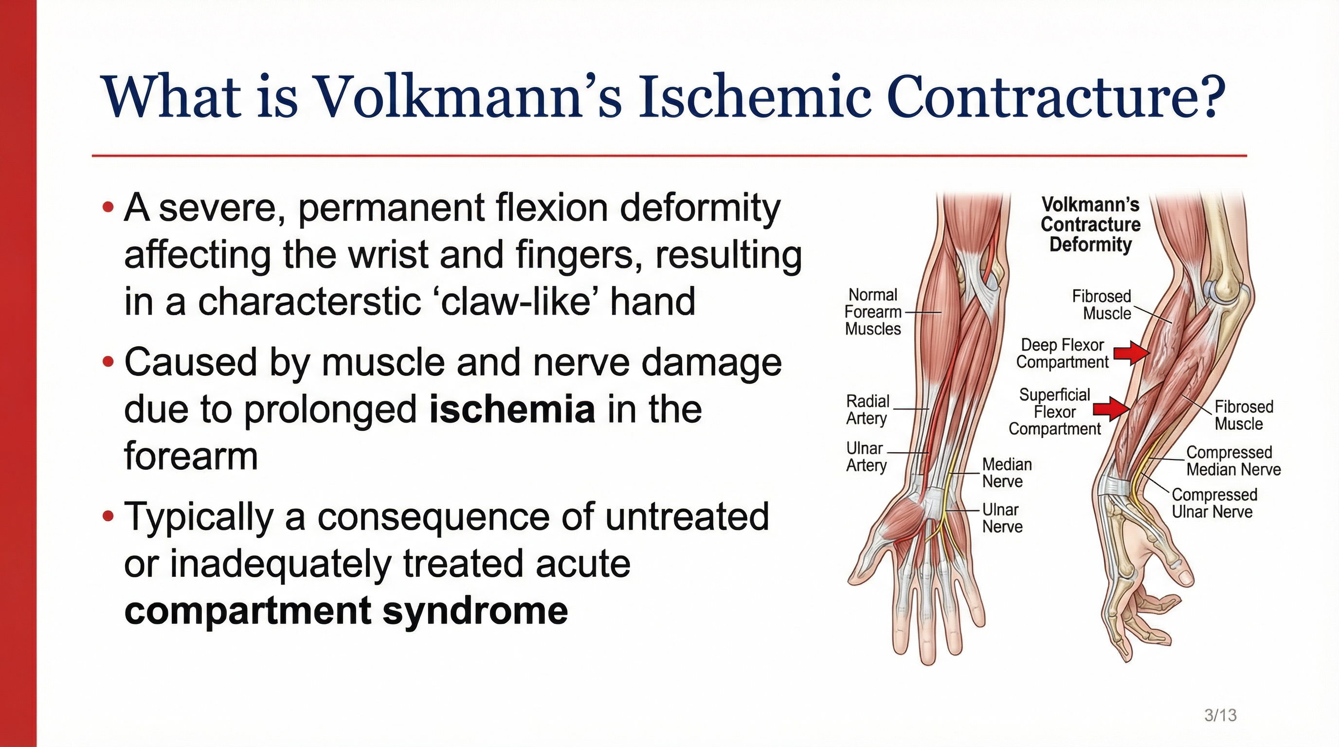 Causes Of Volkmann's Ischemic Contracture